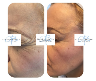 BOTULINO – Claudio Bravin – Medicina Estetica